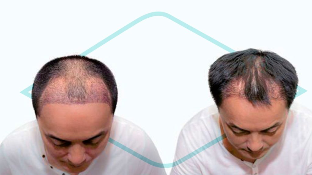 Técnica FUE Archives • Kaloni Hair