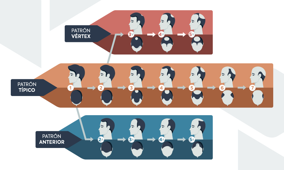 Grados de alopecia y la Escala de Hamilton Noorwod