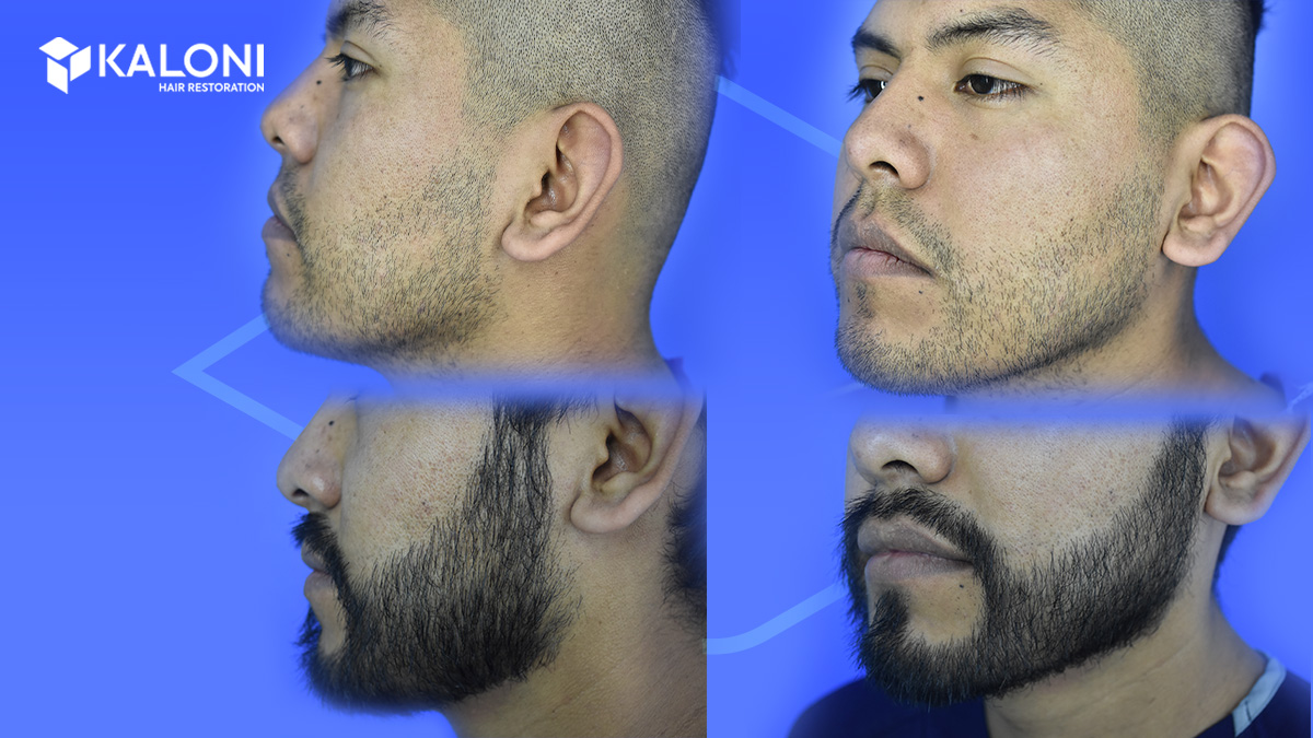 Injerto de Barba. Antes y después. Clínica Capilar Kaloni.