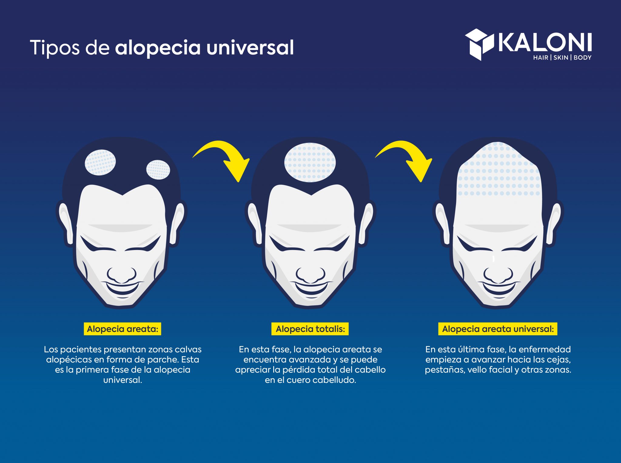Alopecia Universal. Síntomas y tratamientos. Costo y precio.
